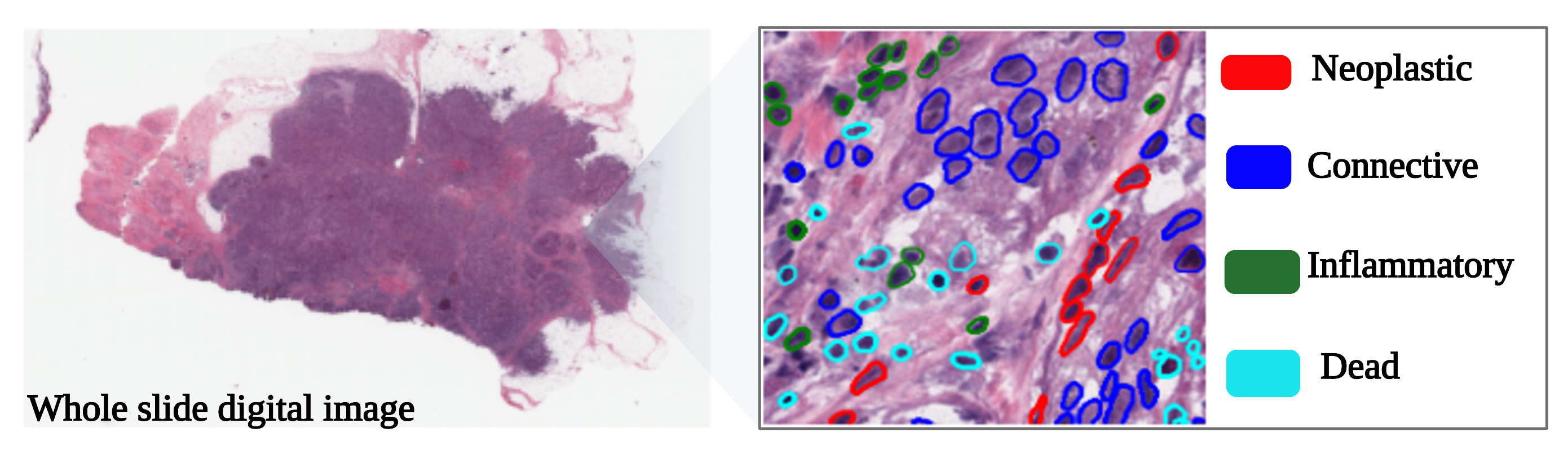 AI-powered deep learning model can improve cancer diagnostics by ...