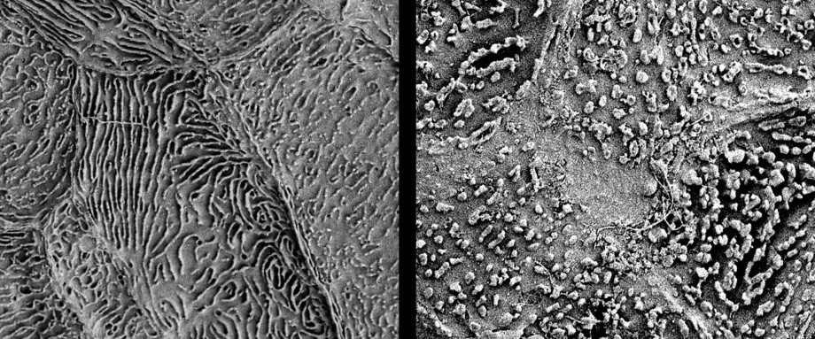 Monikeskustutkimus valottaa sädehoidon vaikutuksia suun alueen ...