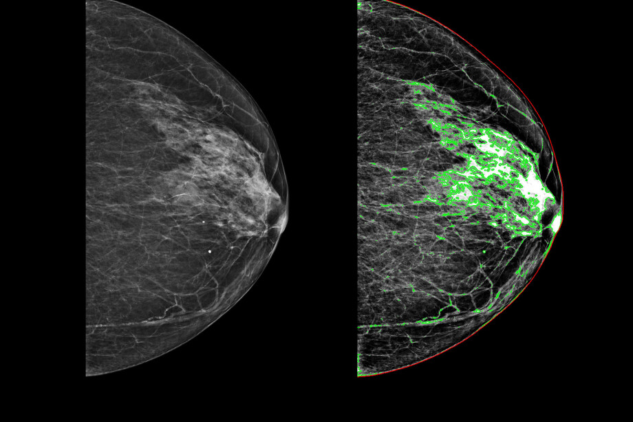 New deep learning challenge to estimate breast density from mammograms ...